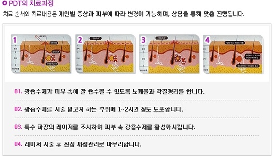 Pdt 요법으로 여드름 여드름흉터 기미 주근깨 모공까지 한번에 해결 네이버 블로그