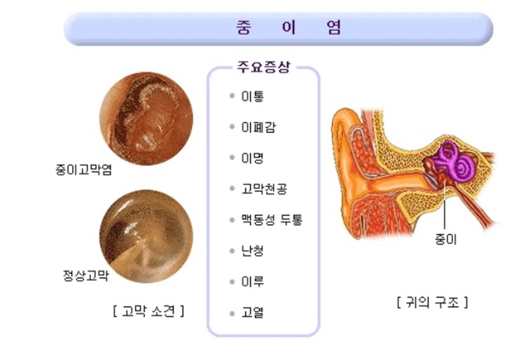 중이염 증상과 중이염 치료 중이염 원인에 대해 알아볼께요 네이버 블로그