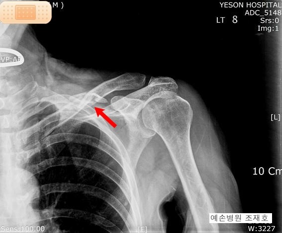 쇄골 분쇄골절빗장뼈 골절에서의 관혈적 정복술 및 내고정술orif At Comminuted Clavicle Fracture
