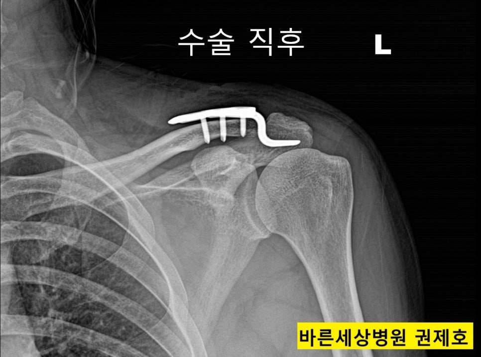 어깨 탈구 및 쇄골 돌출 치료 예 바른세상병원 권제호 네이버 블로그