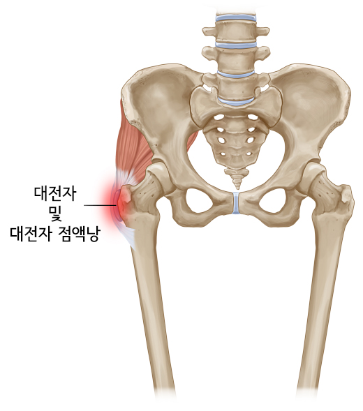 대전자 동통 증후군이란 광나루역 강변역 구의역 굿닥터정형외과의원 네이버 블로그