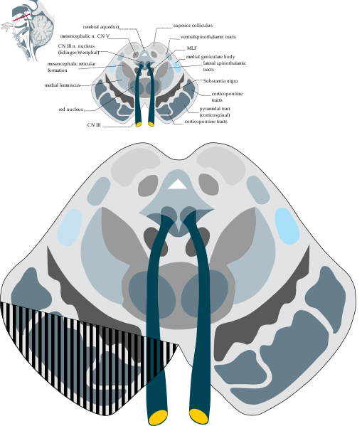 뇌간(brain stem)의 단면구조와 Brain stem stroke syndrome : 네이버 블로그