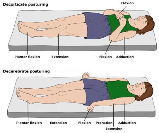 GCS score & Mental status : 네이버 블로그