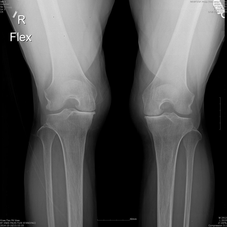 part6. Lower extremity 방사선검사메뉴얼 : 네이버 블로그