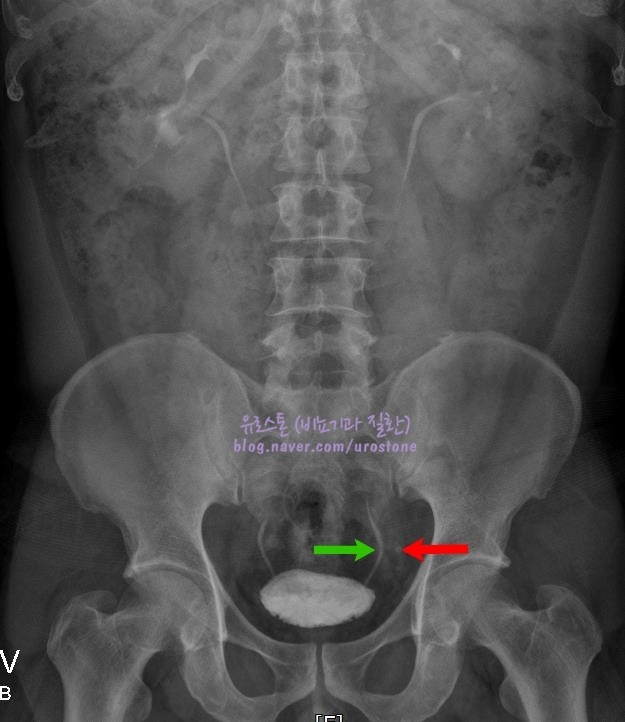 요로결석진단 & 요로결석 검사 : 요로결석은 x-ray나 초음파로 진단하면 안되는 것인가? 꼭 CT나 IVP(경정맥요로조영술 ...