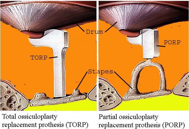 Ossiculoplasty(이소골성형술) : 네이버 블로그