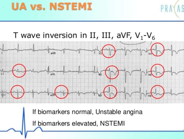 unstable angina : 네이버 블로그