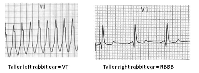 Ventricular tachycardia (VT, 심실빈맥)/원인 , 발생기전 / 특징 / 감별진단 : 네이버 블로그